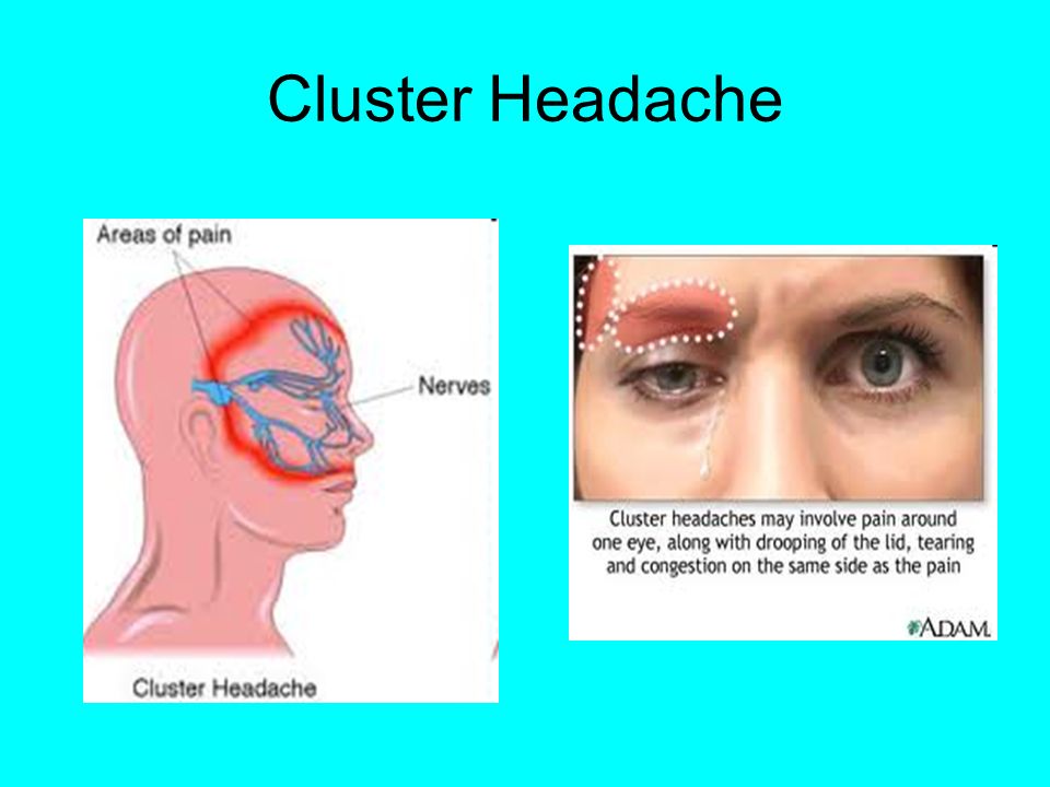 The Story of Cluster Headaches: Discovering Ways to Relieve the Pain ...