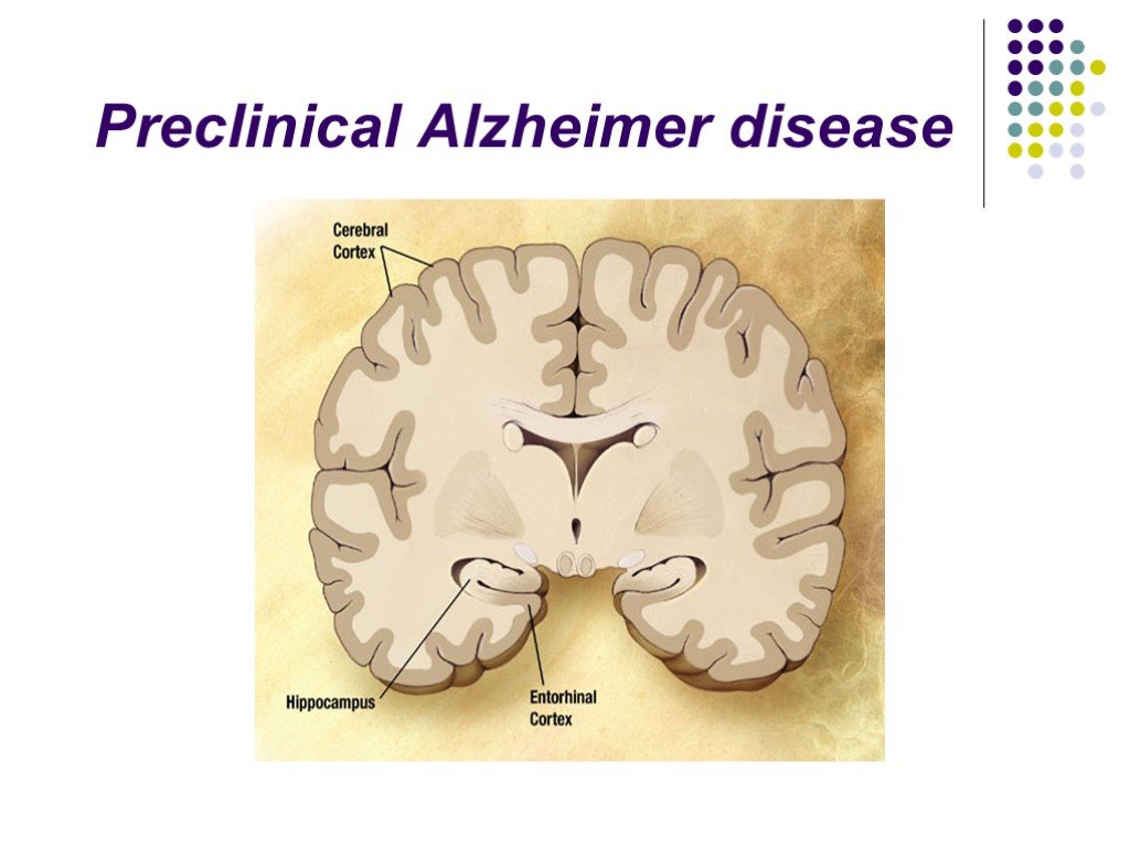 What are the Stages of Alzheimer's Disease? - Life Conceptual