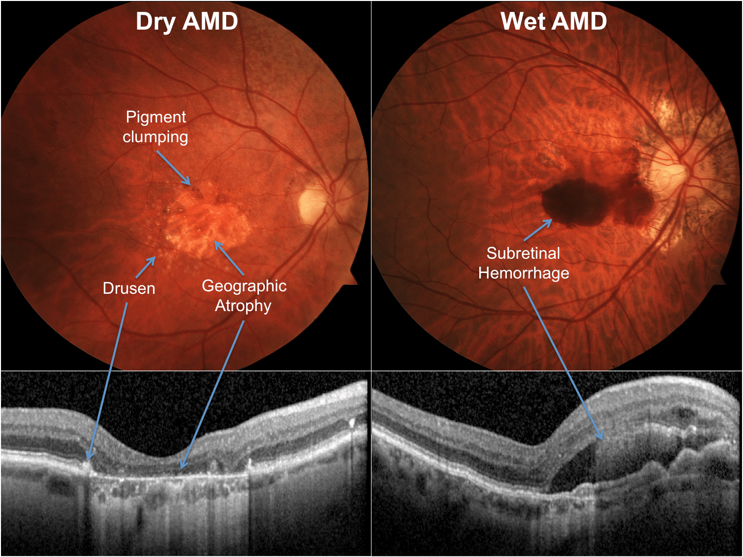 Eyes and Aging: Addressing Four Serious Vision Concerns