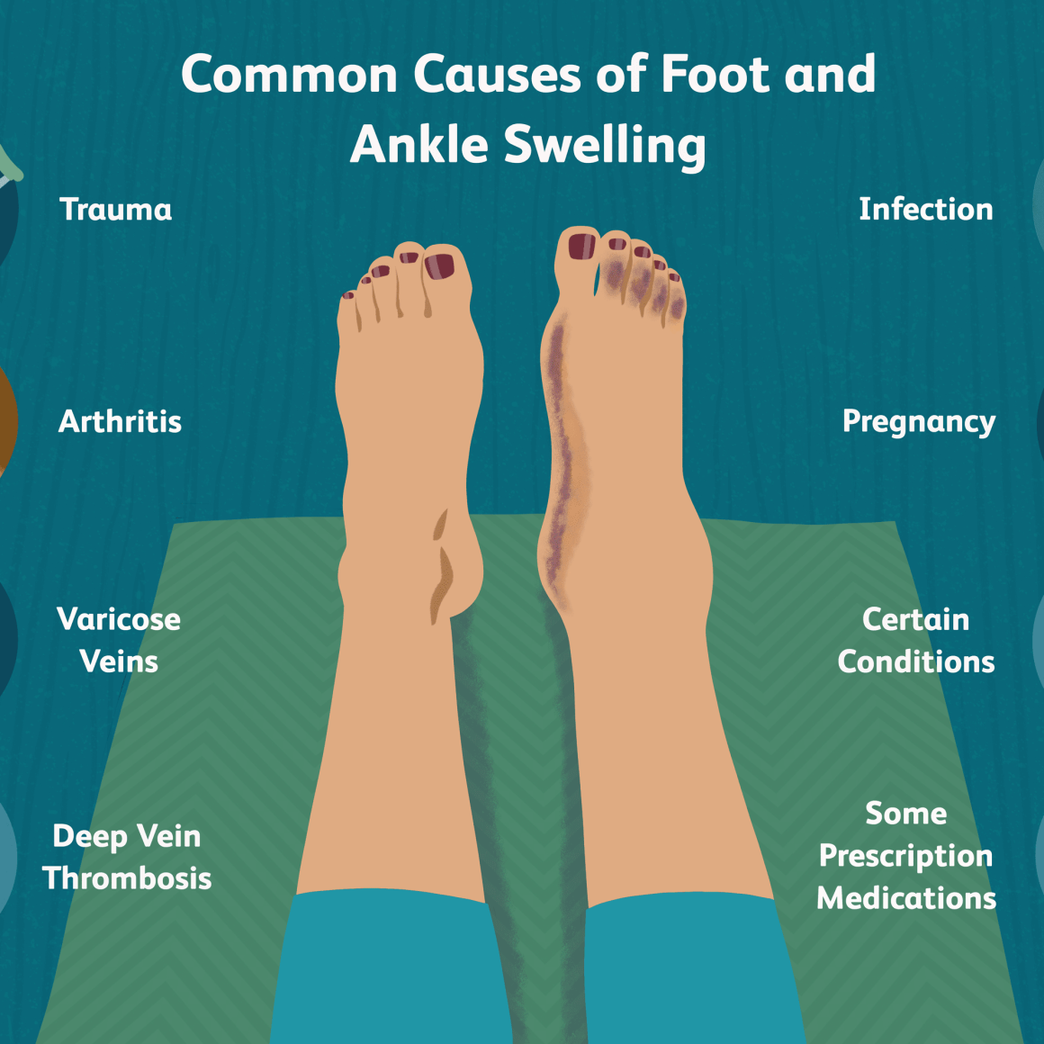 Understanding Swollen Ankles: Causes, Symptoms, and Solutions