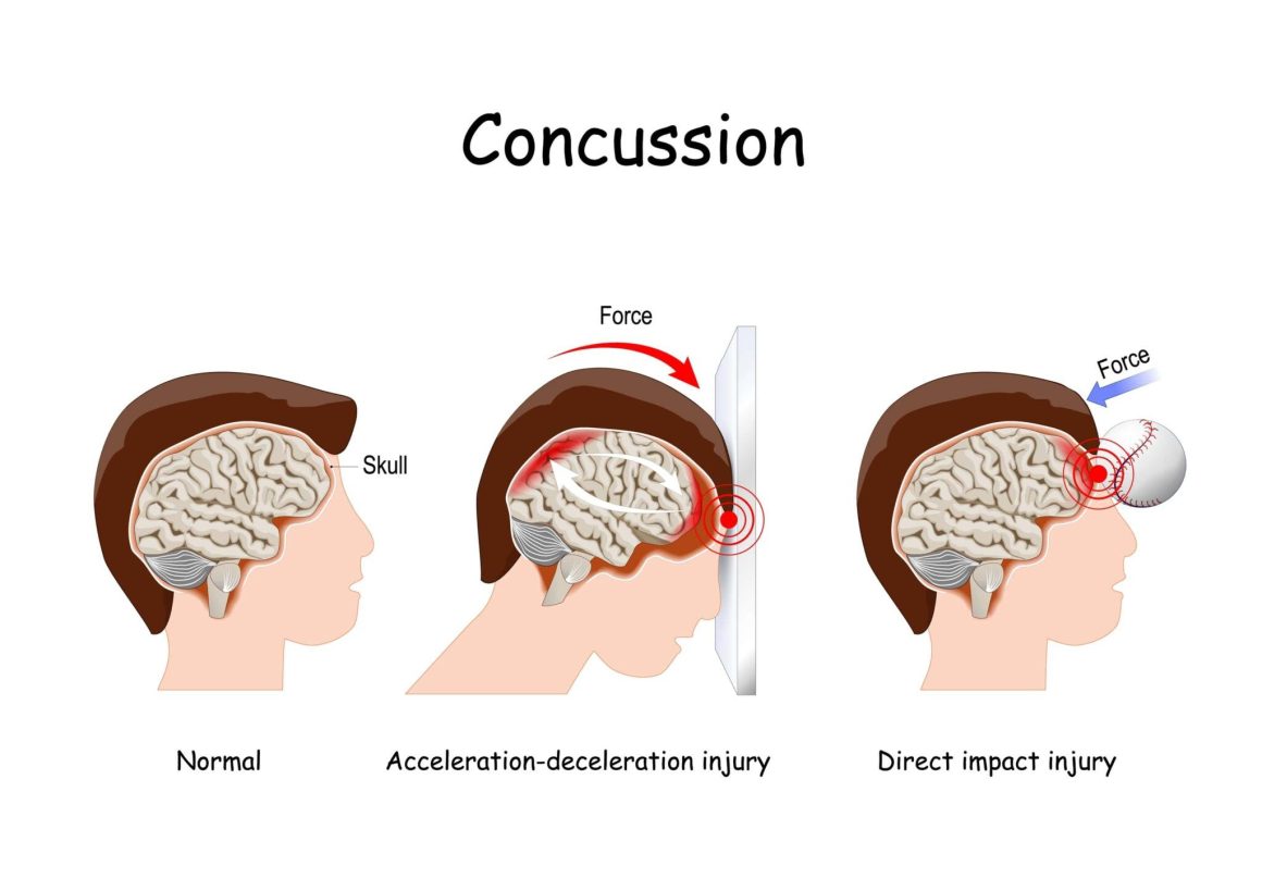 Finding Out if You Have a Concussion: What to Look For