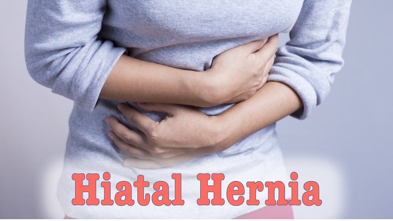 Getting to Know Hiatus Hernia: The Basics Simplified - Life Conceptual