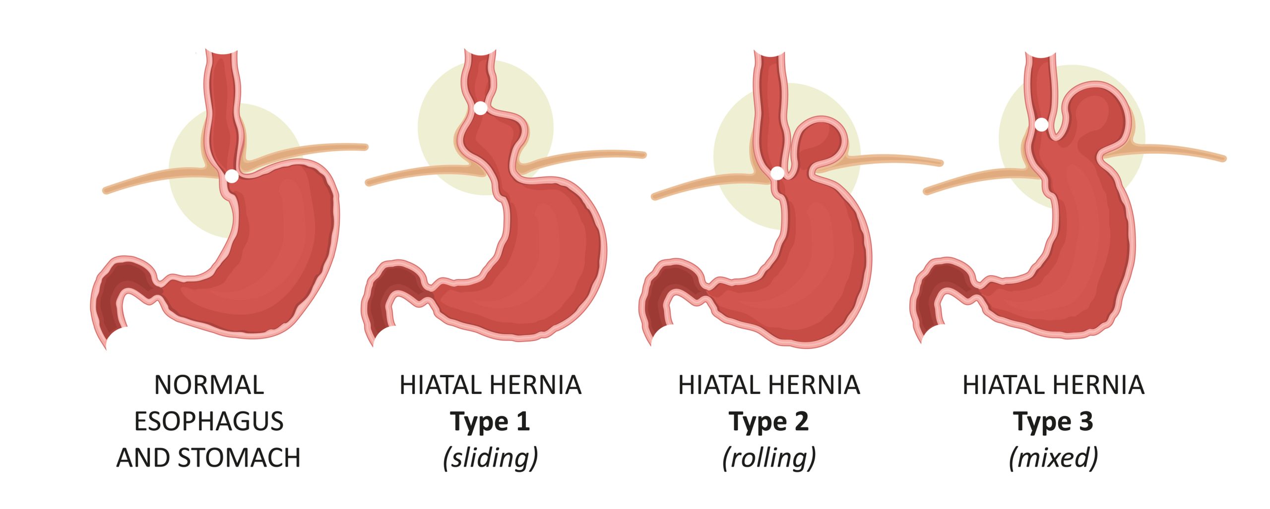 Getting to Know Hiatus Hernia: The Basics Simplified - Life Conceptual