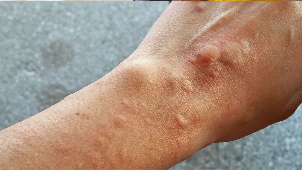 Ringworm Revealed: Essential Facts and Action Steps