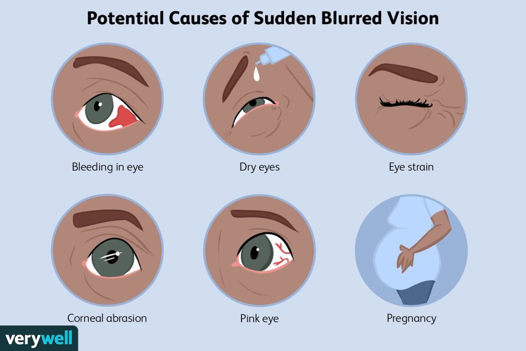 Understanding Temporary Eye Blindness: Not Always a Stroke