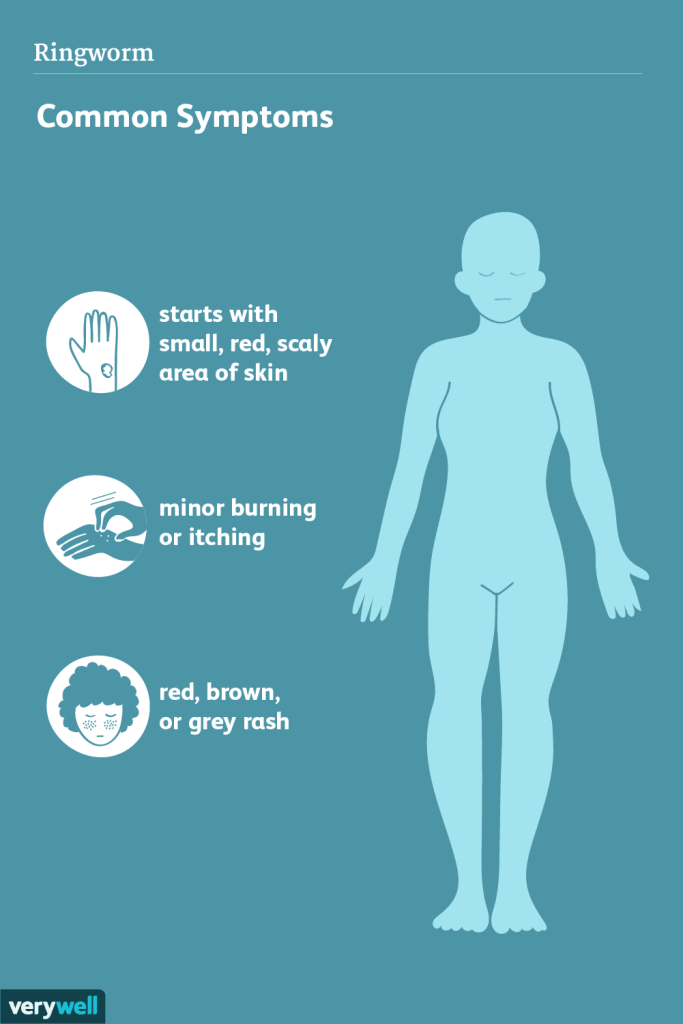 Ringworm Revealed: Essential Facts and Action Steps